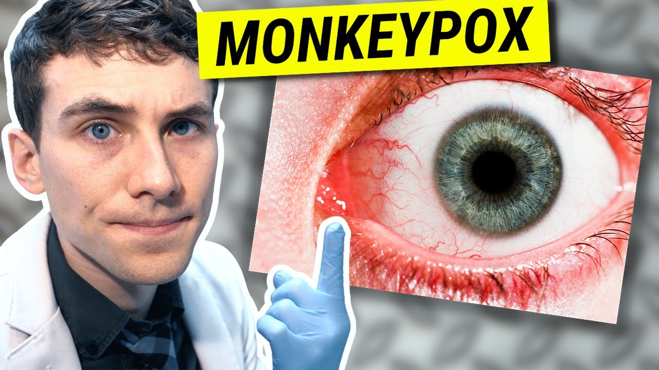 Monkeypox And The Eyes: Everything You Need To Know